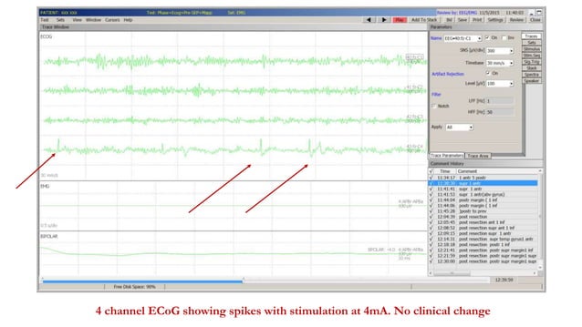 Cortical stimulation and mapping | PPTX | Brain and Nervous System ...