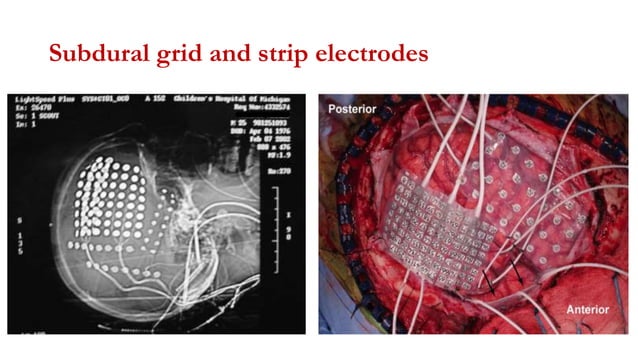Cortical stimulation and mapping | PPTX | Brain and Nervous System ...