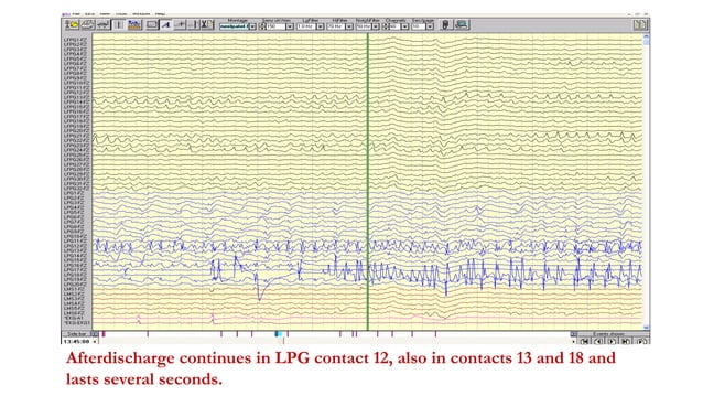 Cortical stimulation and mapping | PPTX | Brain and Nervous System ...