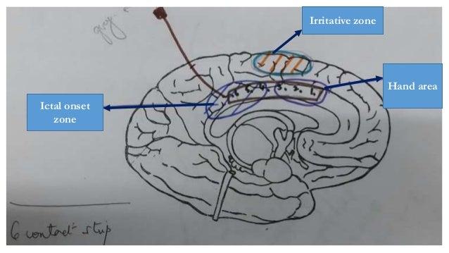 Cortical stimulation and mapping