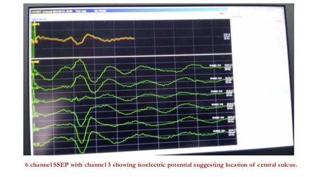 Cortical stimulation and mapping