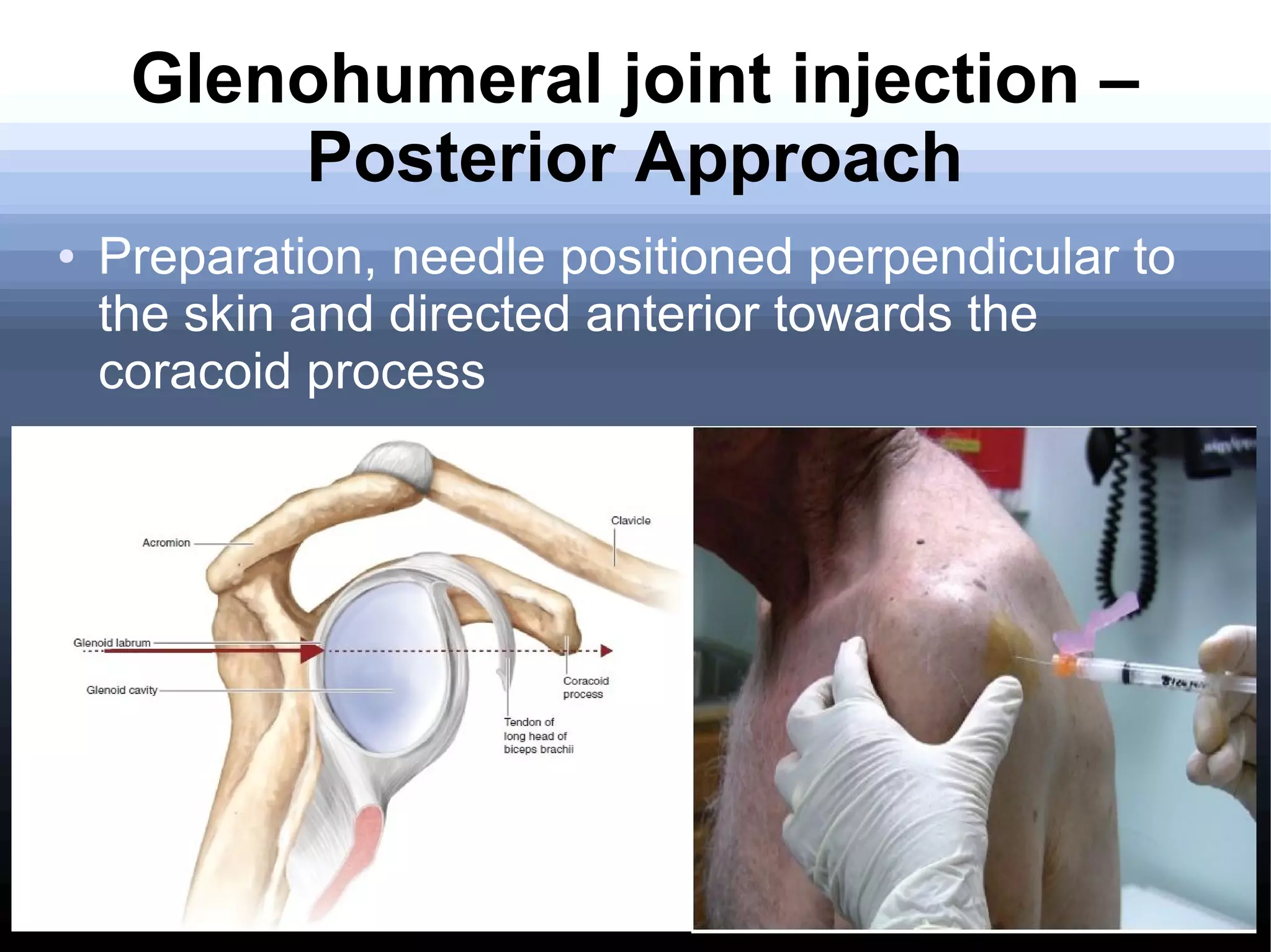 Corticosteroid injections in Orthopaedics | ODP