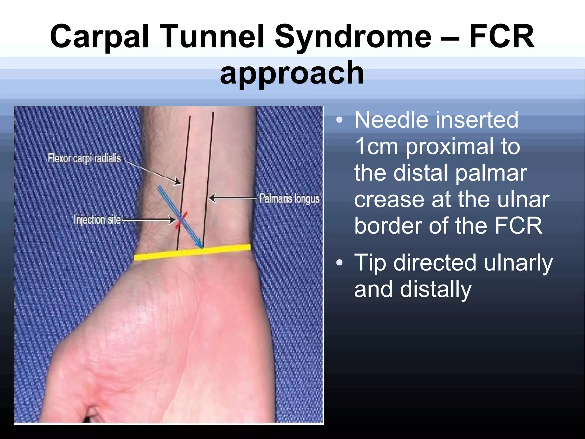 Corticosteroid injections in Orthopaedics | ODP