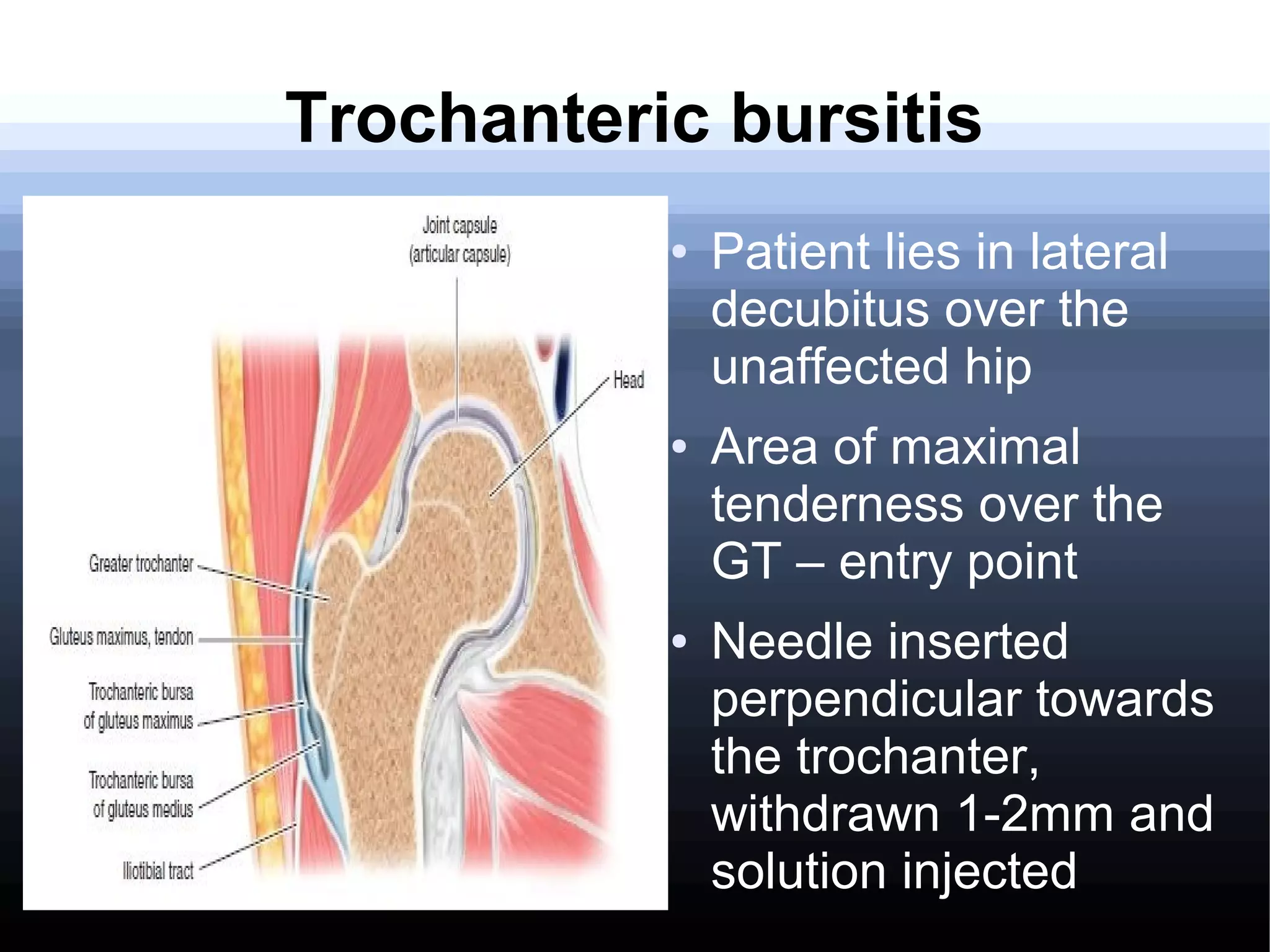 Corticosteroid injections in Orthopaedics | ODP