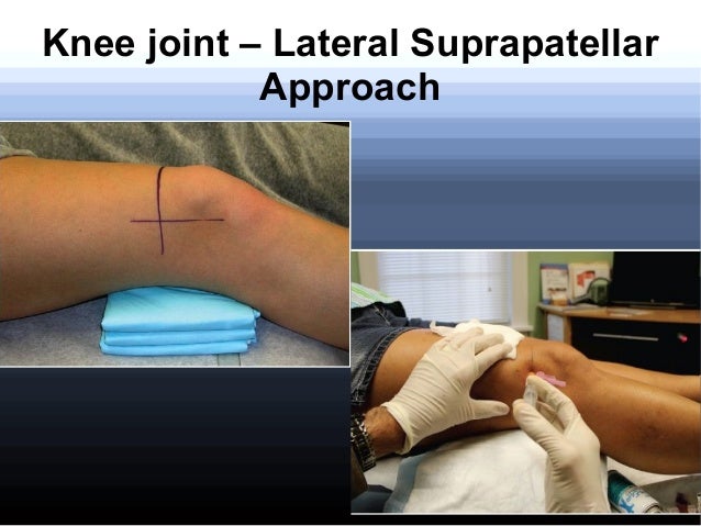 Corticosteroid injections in Orthopaedics