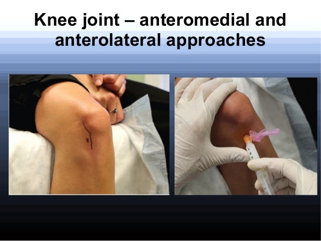 Corticosteroid injections in Orthopaedics