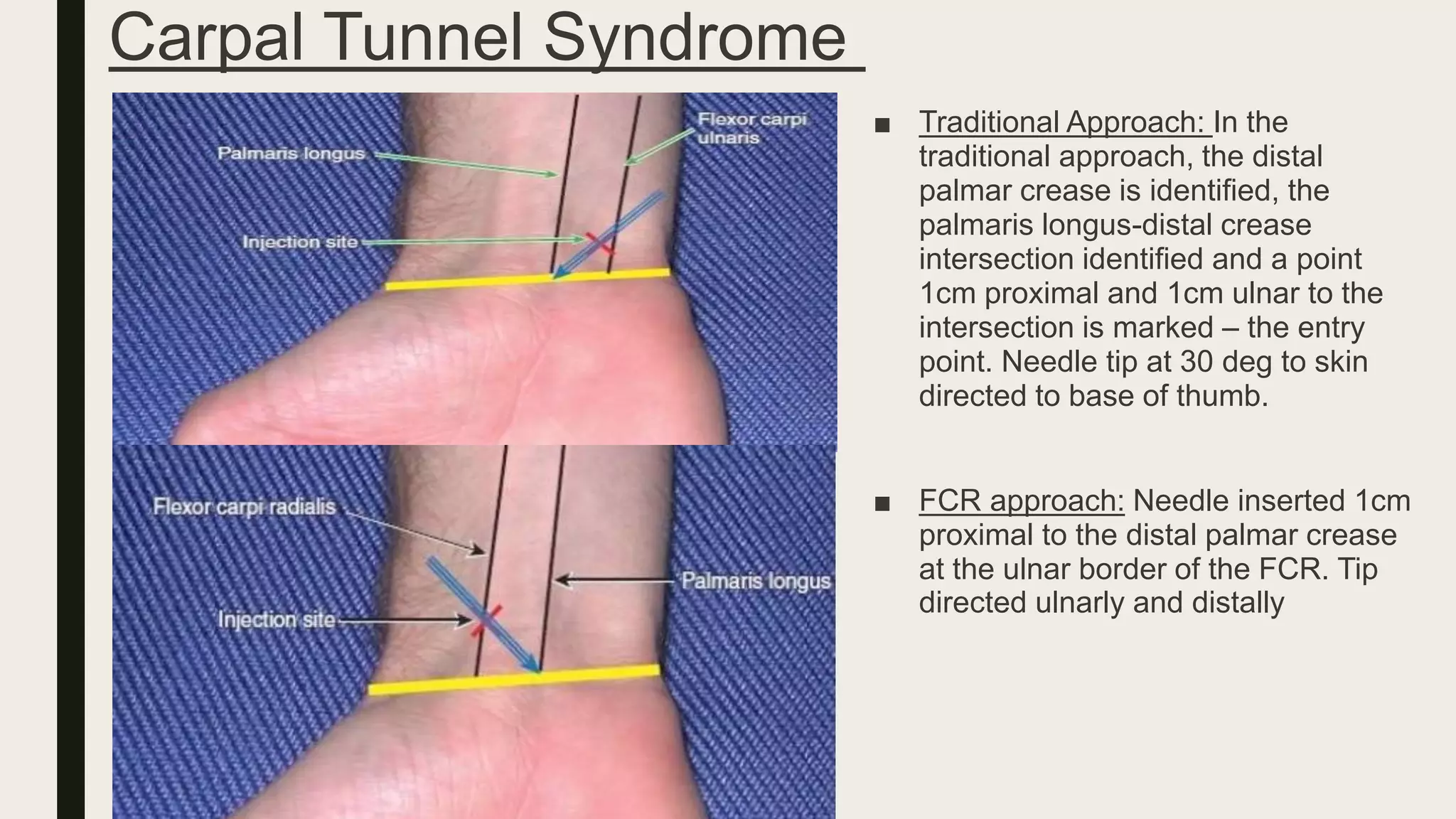 Corticosteroid injection techniques in orthopaedics | PPTX