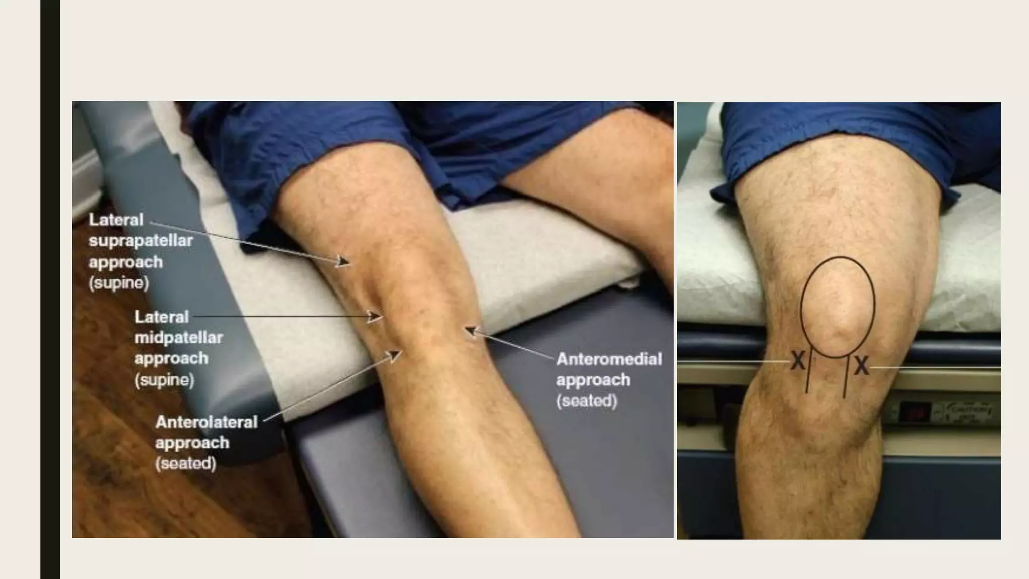 Corticosteroid injection techniques in orthopaedics | PPTX