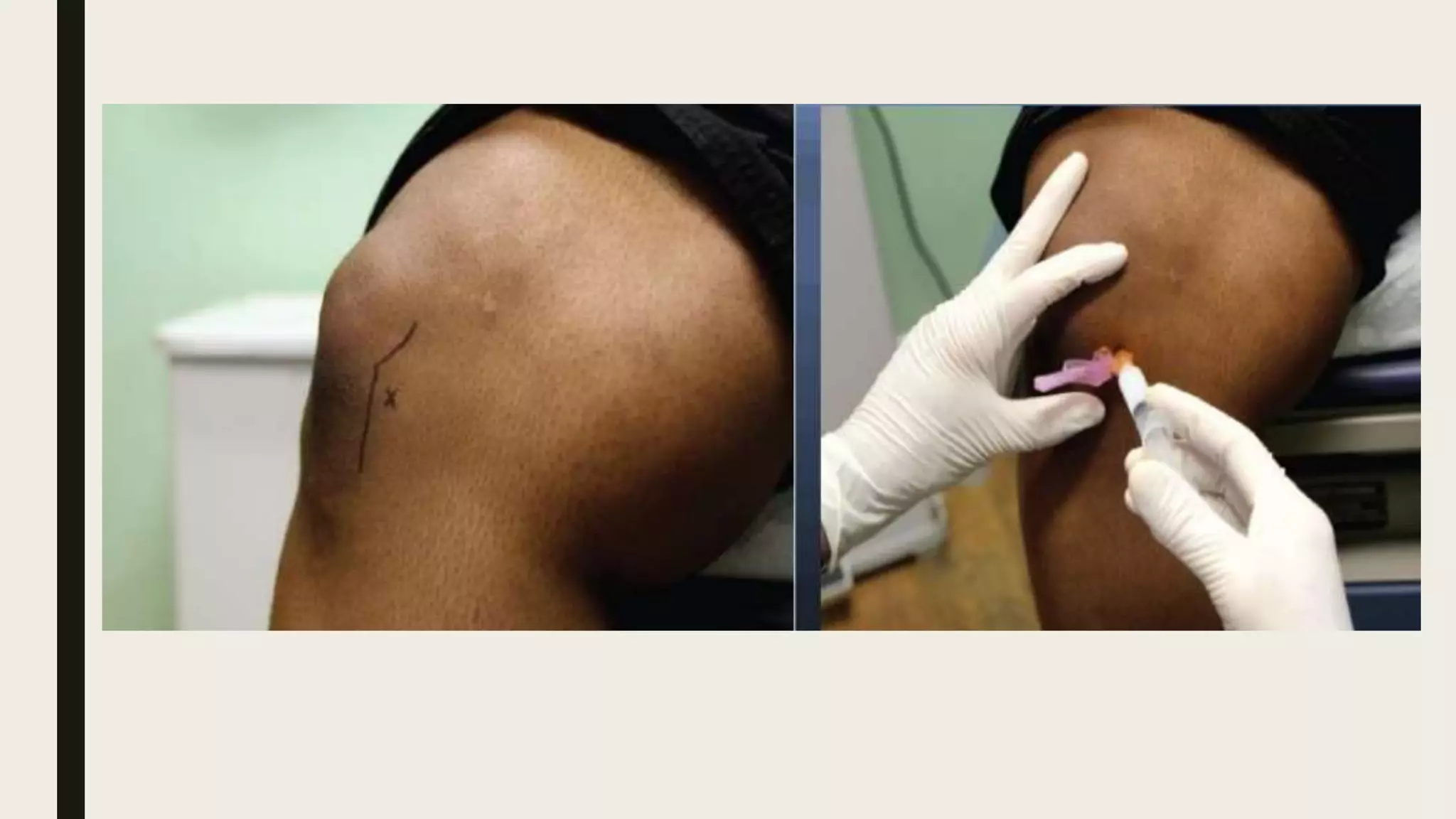 Corticosteroid injection techniques in orthopaedics | PPTX