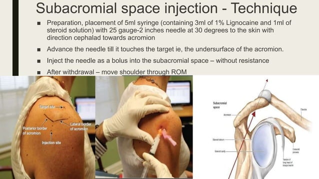 Corticosteroid injection techniques in orthopaedics | PPTX | Death ...