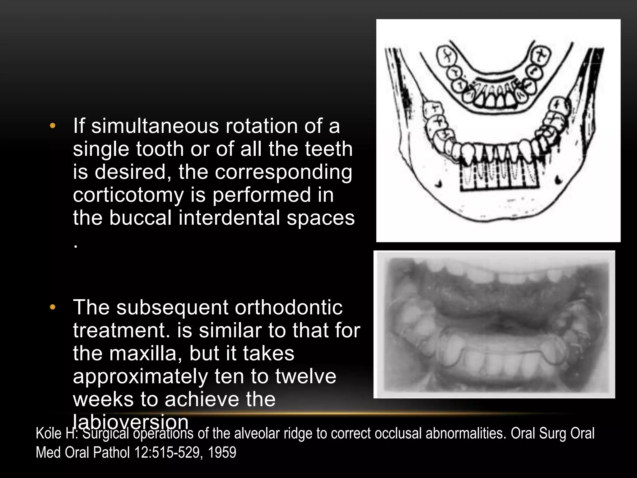 Corticotomy for Rapid Acceleration | PPTX