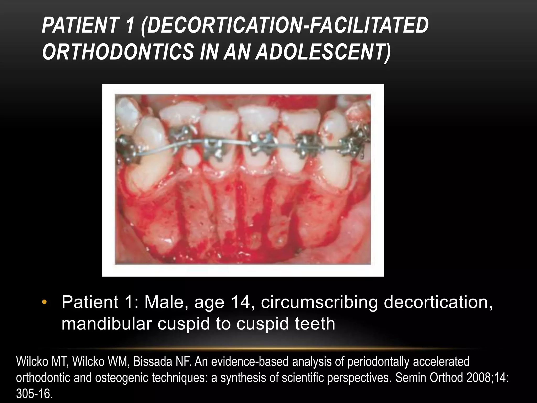 Corticotomy for Rapid Acceleration | PPTX