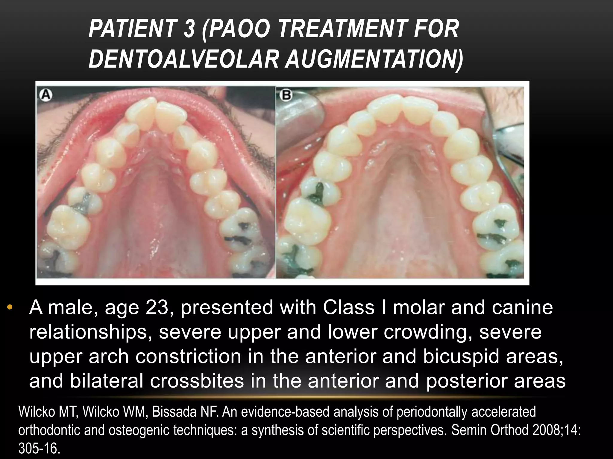 Corticotomy for Rapid Acceleration | PPTX