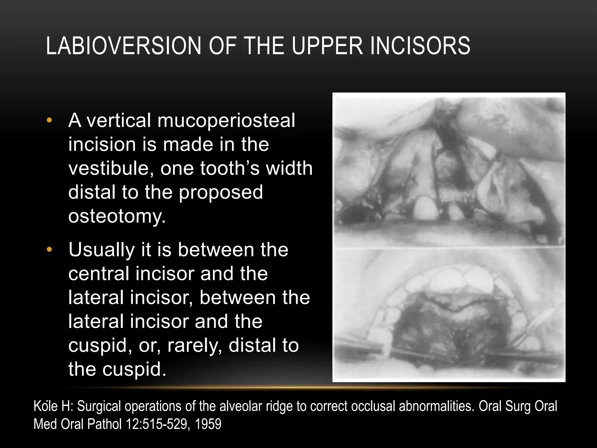 Corticotomy for Rapid Acceleration | PPTX