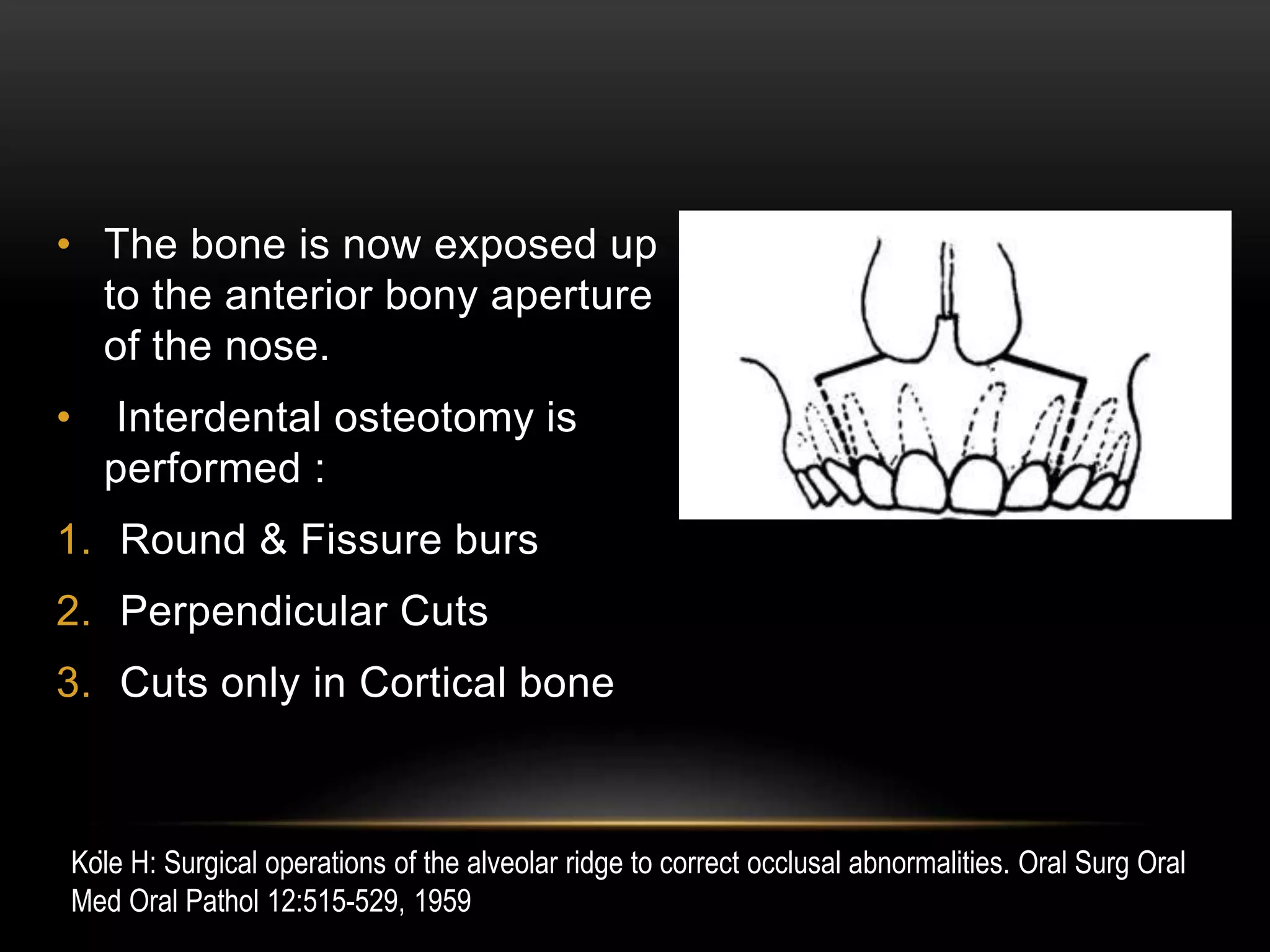 Corticotomy for Rapid Acceleration | PPTX