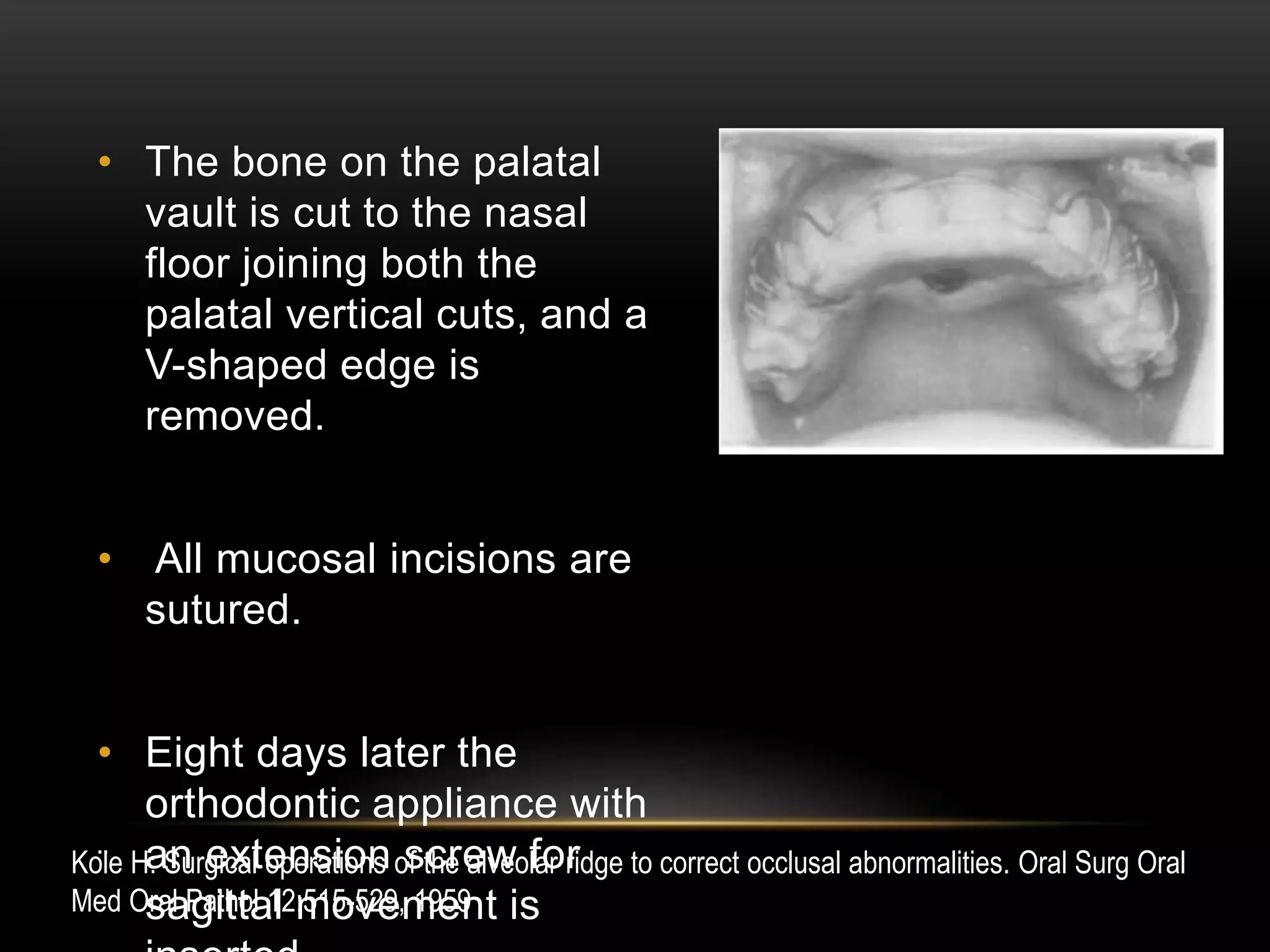 Corticotomy for Rapid Acceleration | PPTX