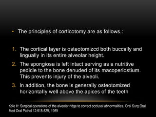 Corticotomy for Rapid Acceleration | PPTX