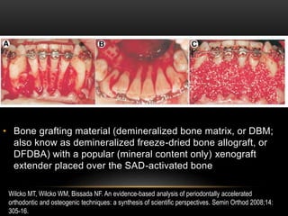 Corticotomy for Rapid Acceleration | PPTX