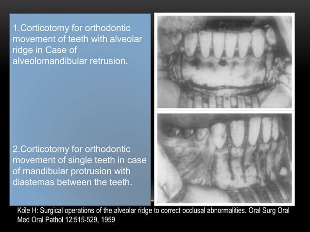 Corticotomy for Rapid Acceleration | PPTX | Dental Health | Diseases ...