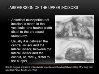 Corticotomy for Rapid Acceleration | PPTX
