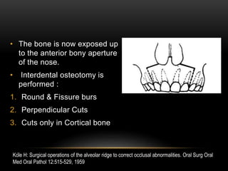 Corticotomy for Rapid Acceleration | PPTX