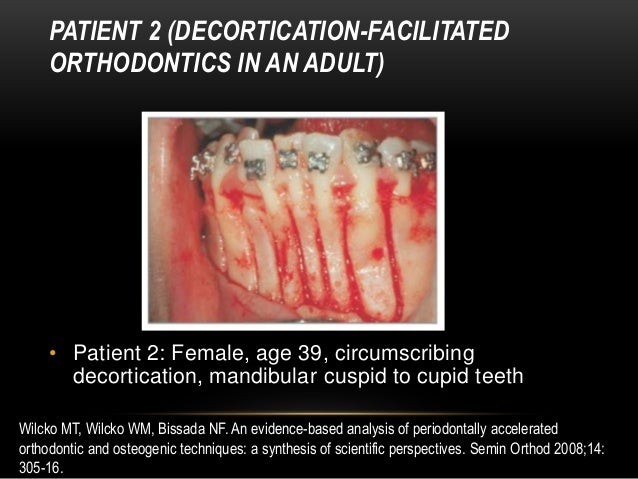 Corticotomy for Rapid Acceleration