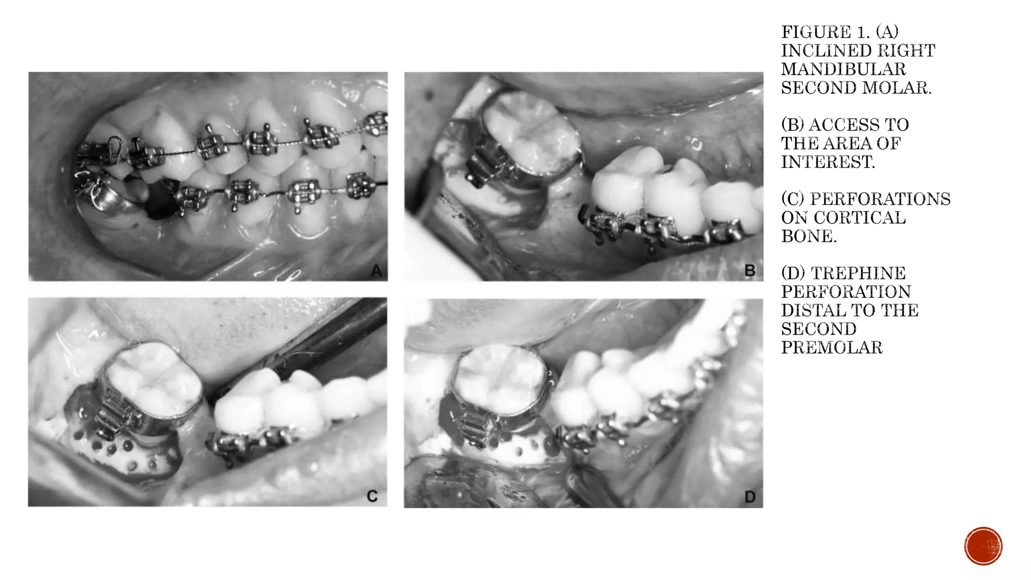 Corticotomy | PPTX