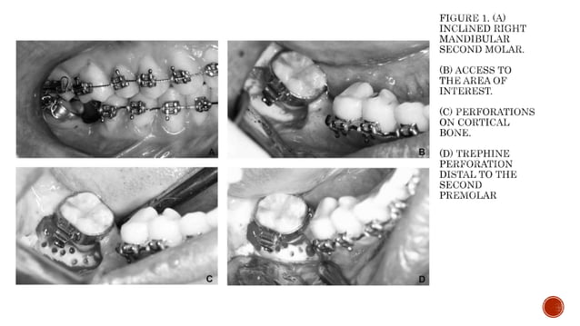 Corticotomy | PPTX