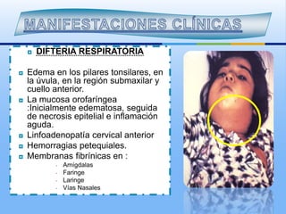Corynebacterium(difteria) | PPTX