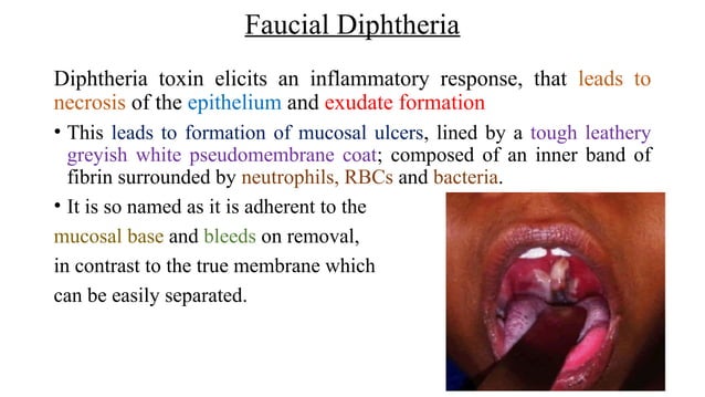 CORYNEBACTERIUM DIPHTHERIAE (Diphtheria) GPB.pptx | Ear, Nose and ...