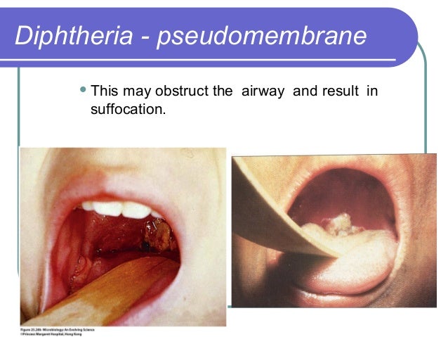 Corynebacterium diptheriae(Microbiology)