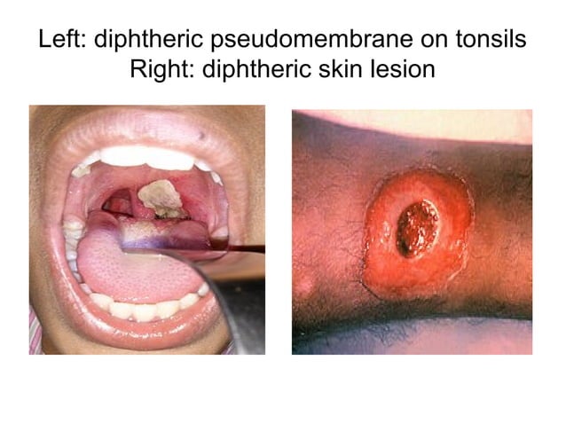 Corynebacterium listeria erysipelothrix_bacillus | PPT