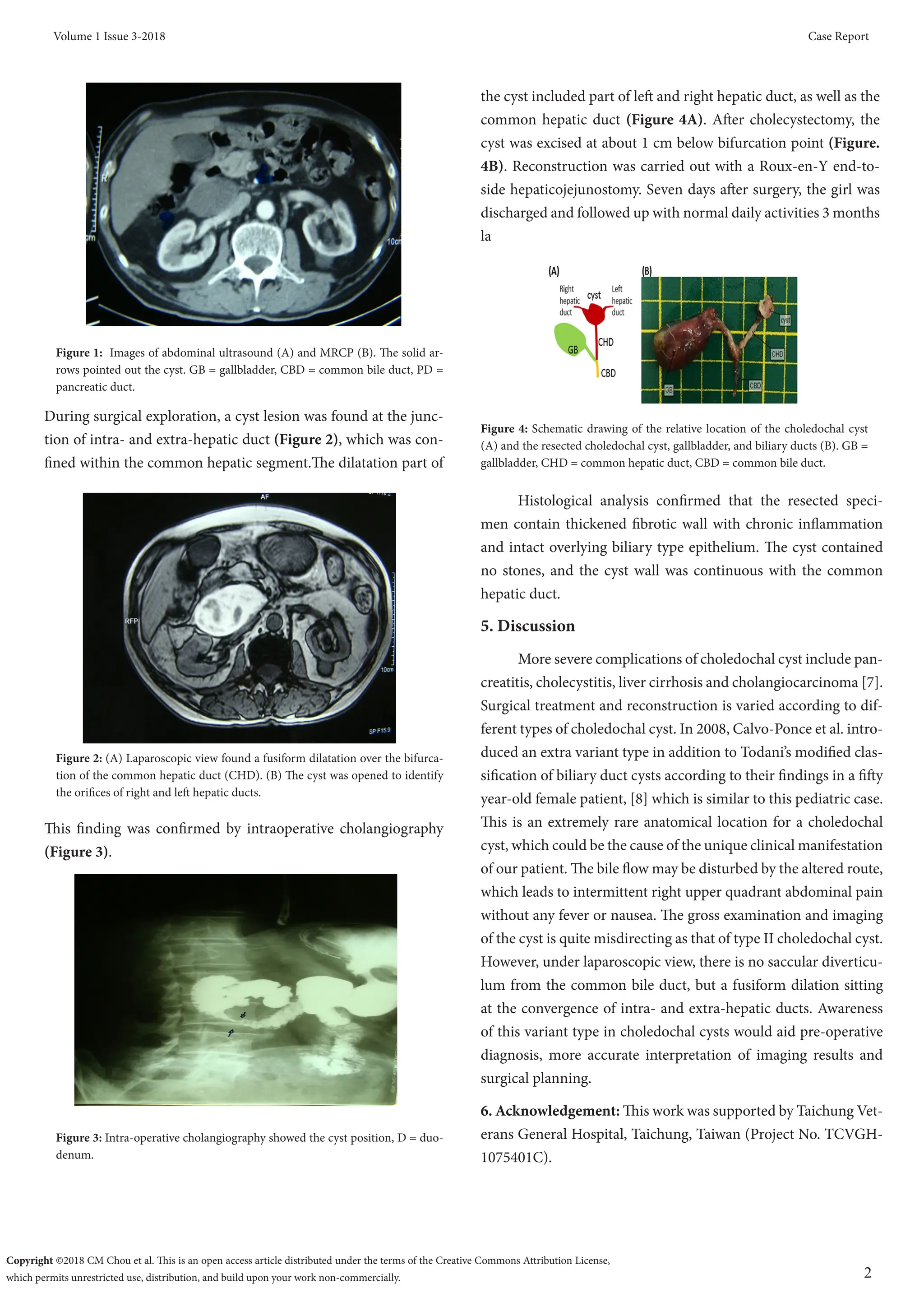 A Rare Case of Choledochal Cyst Connecting Intra- And ExtraHepatic Duct | PDF