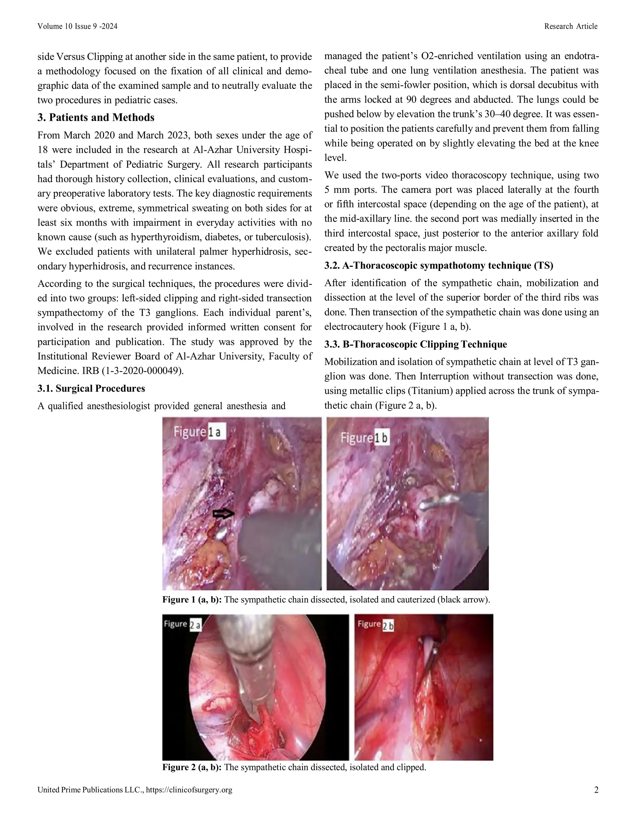 Comparing Electro-Coagulation and Clipping for Palmar Hyperhidrosis in ...