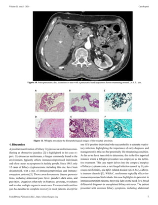 Biliary Cryptococcus Neoformans Manifesting as Obstructive Jaundice ...