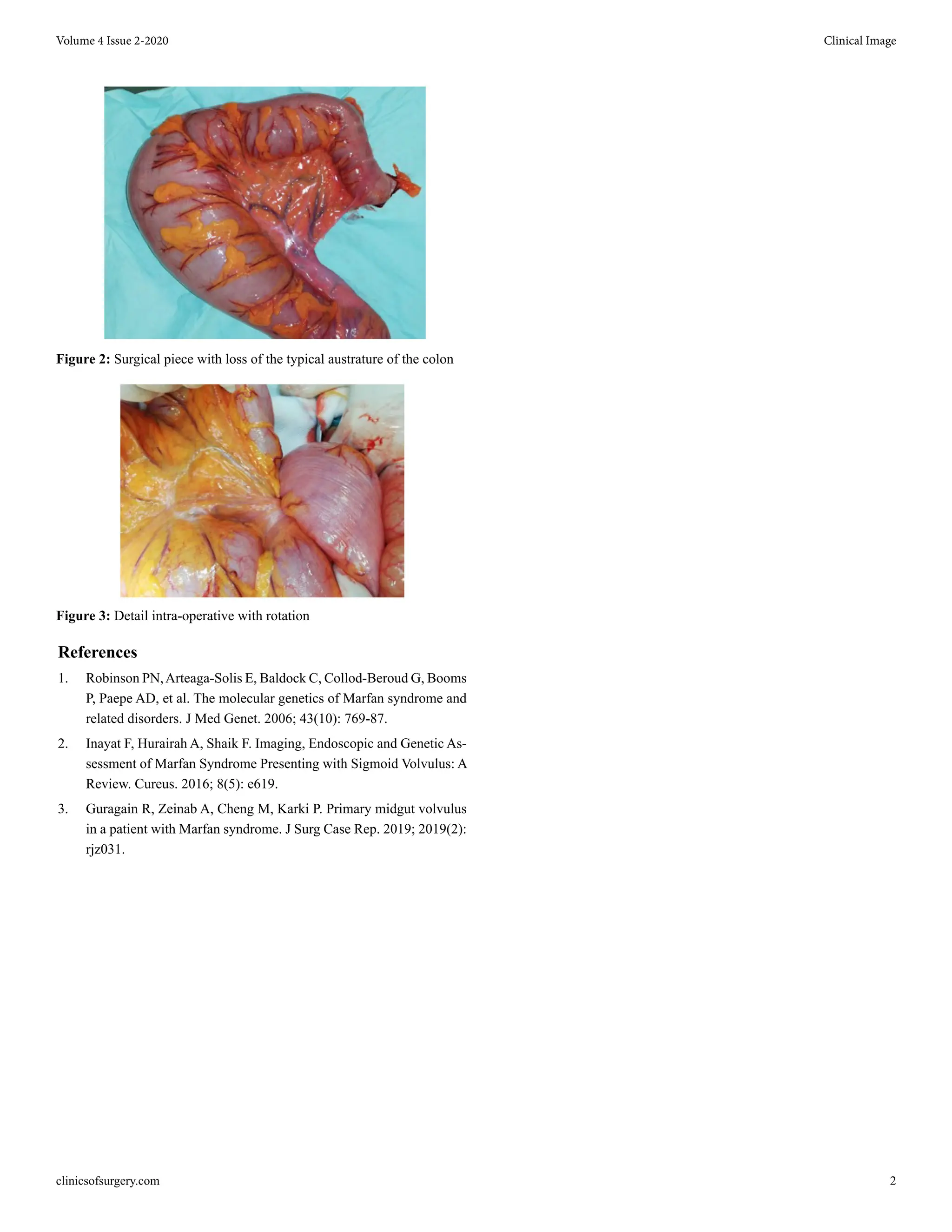 Colonic Volvulus in Patient with Marfan Syndrome: Rare Gastrointestinal ...