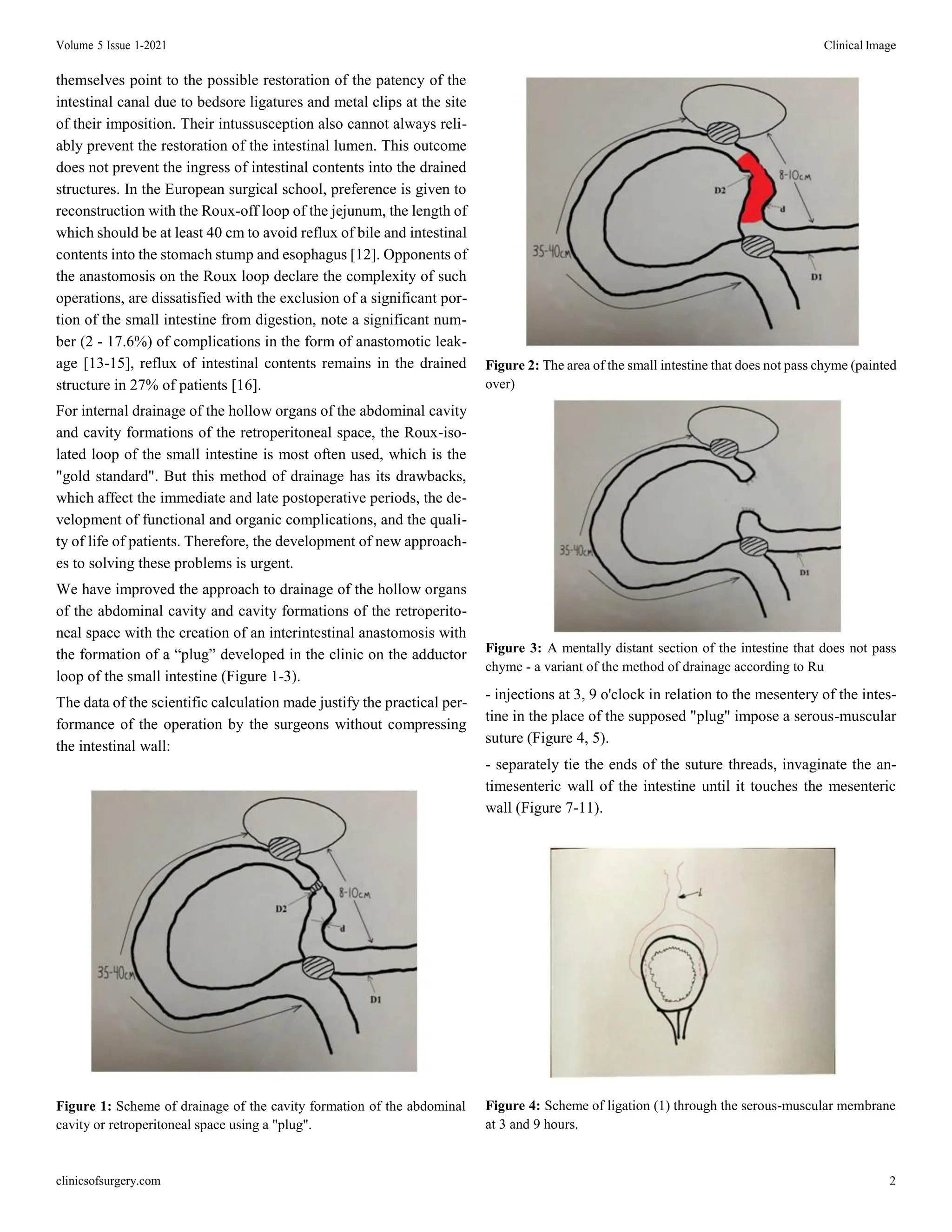 Method for the Formation of a Reflux Pancreatojejunostomy | PDF