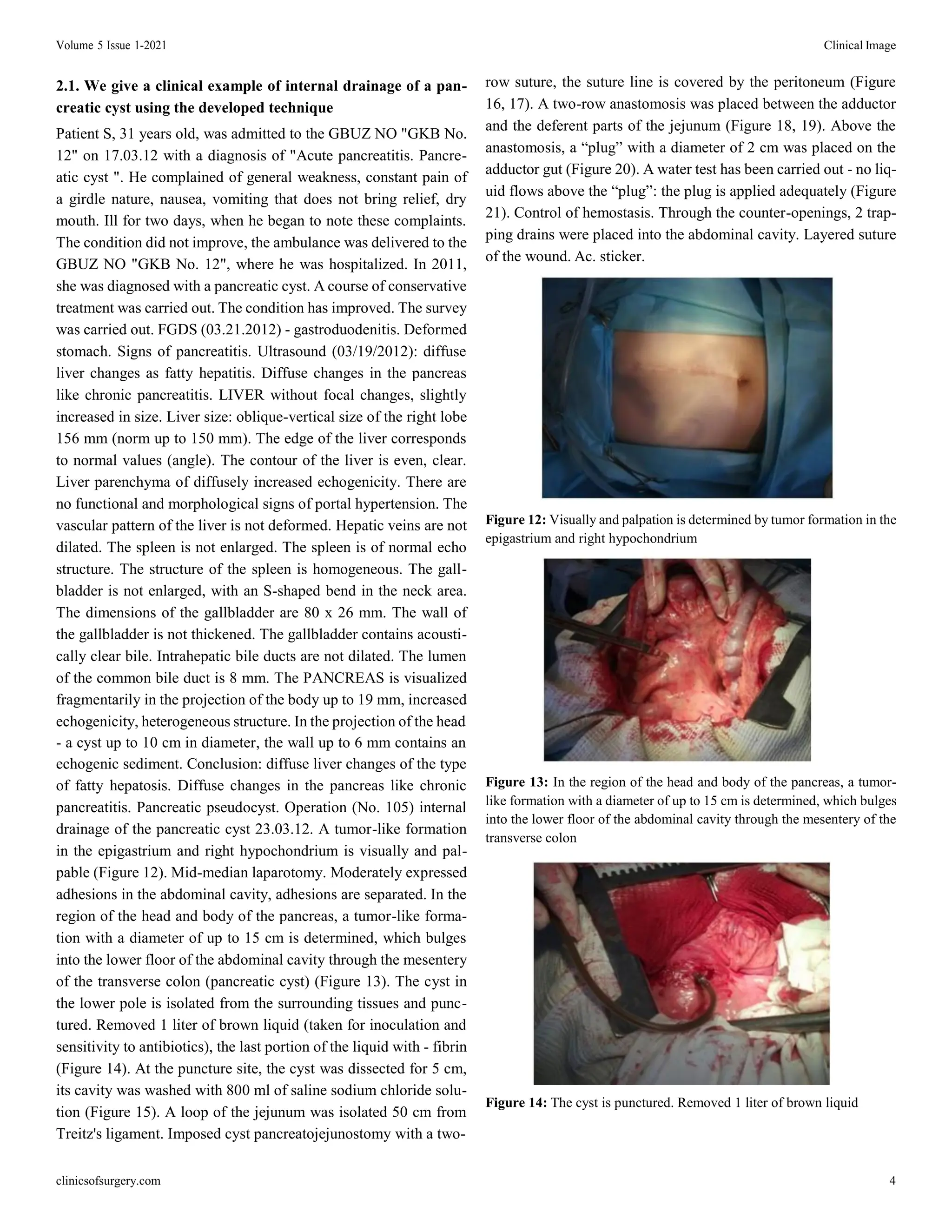 Method for the Formation of a Reflux Pancreatojejunostomy | PDF