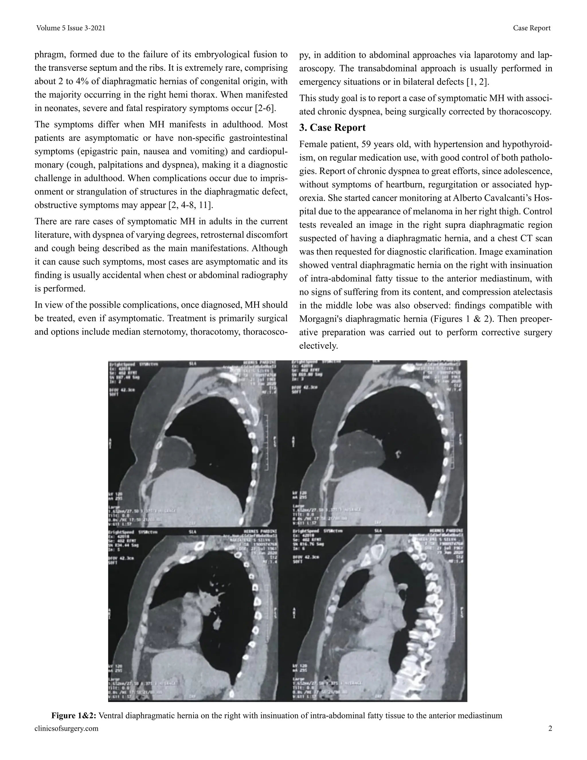 VATS Approach to Symptomatic Morgagni Hernia in Adults | PDF