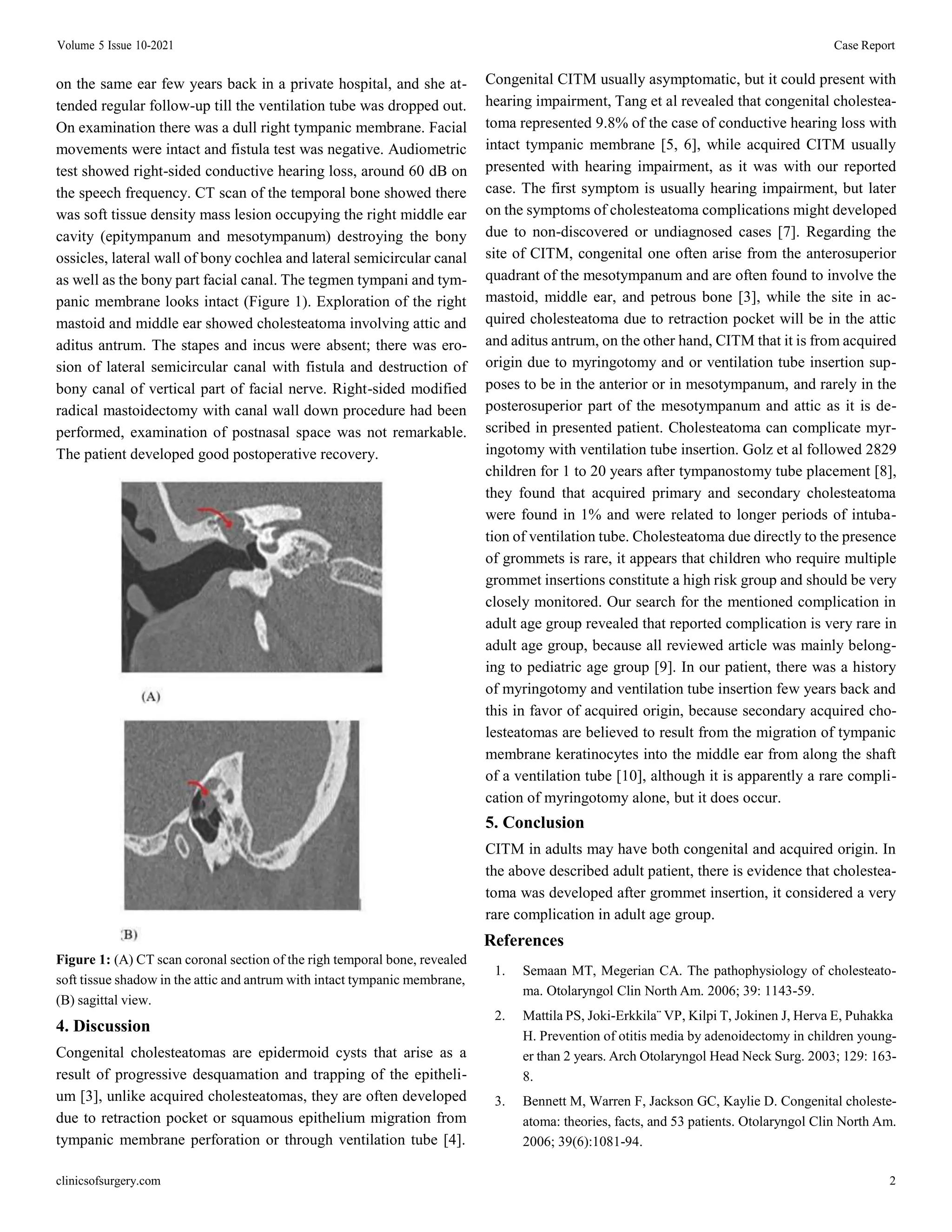 Cholesteatoma Behind Intact Tympanic Membrane: A Complication of ...