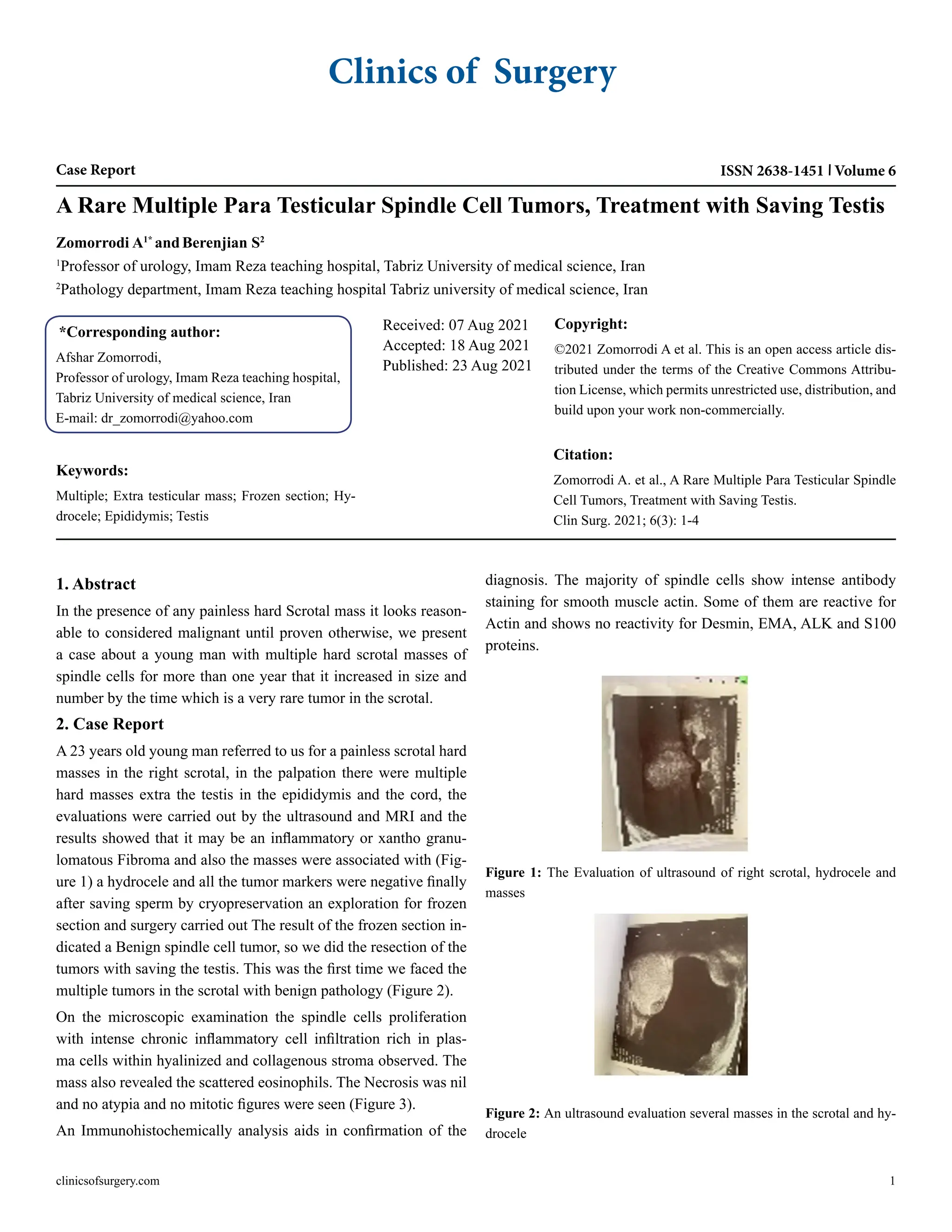 A Rare Multiple Para Testicular Spindle Cell Tumors, Treatment with ...