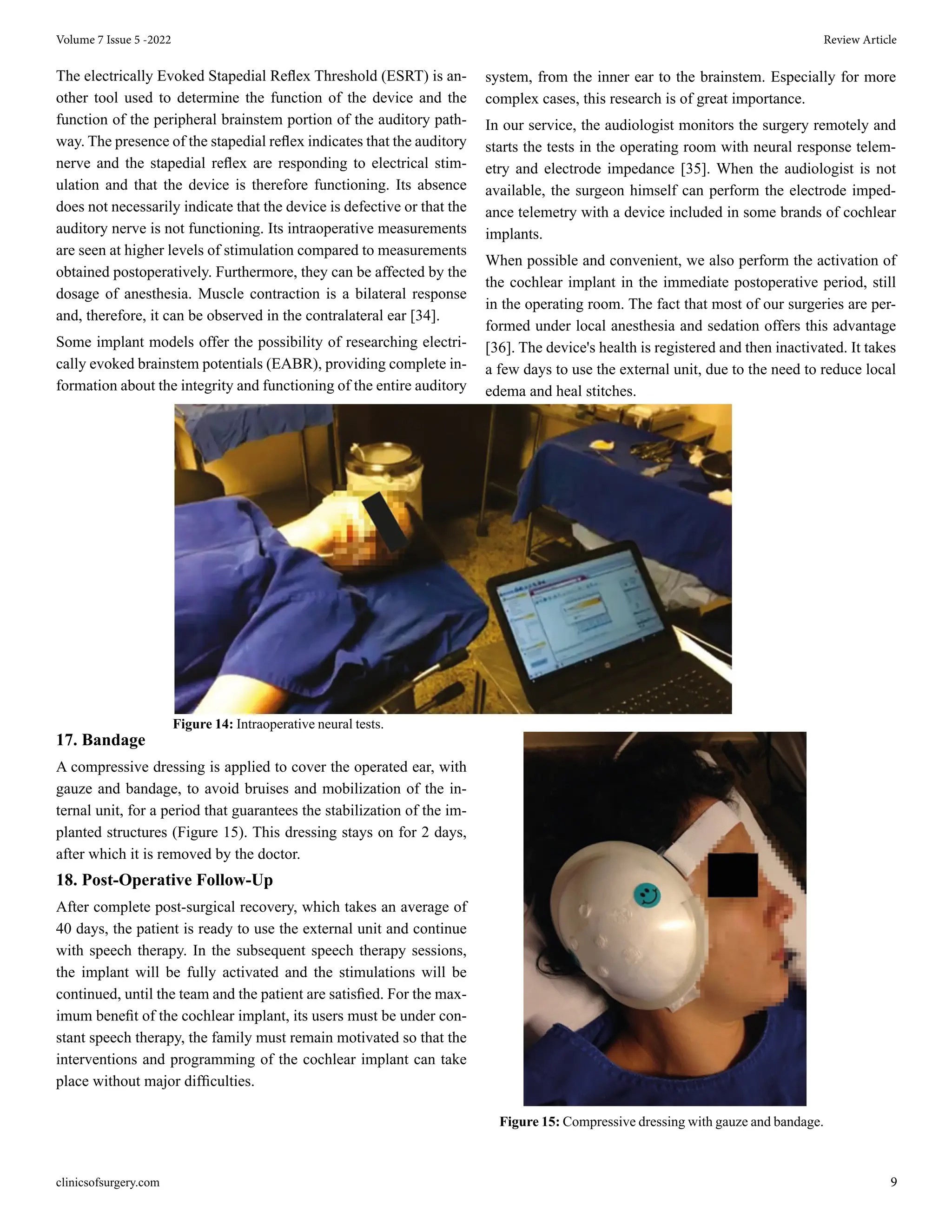 Surgical Technique of Cochlear Implantation: An Update | PDF