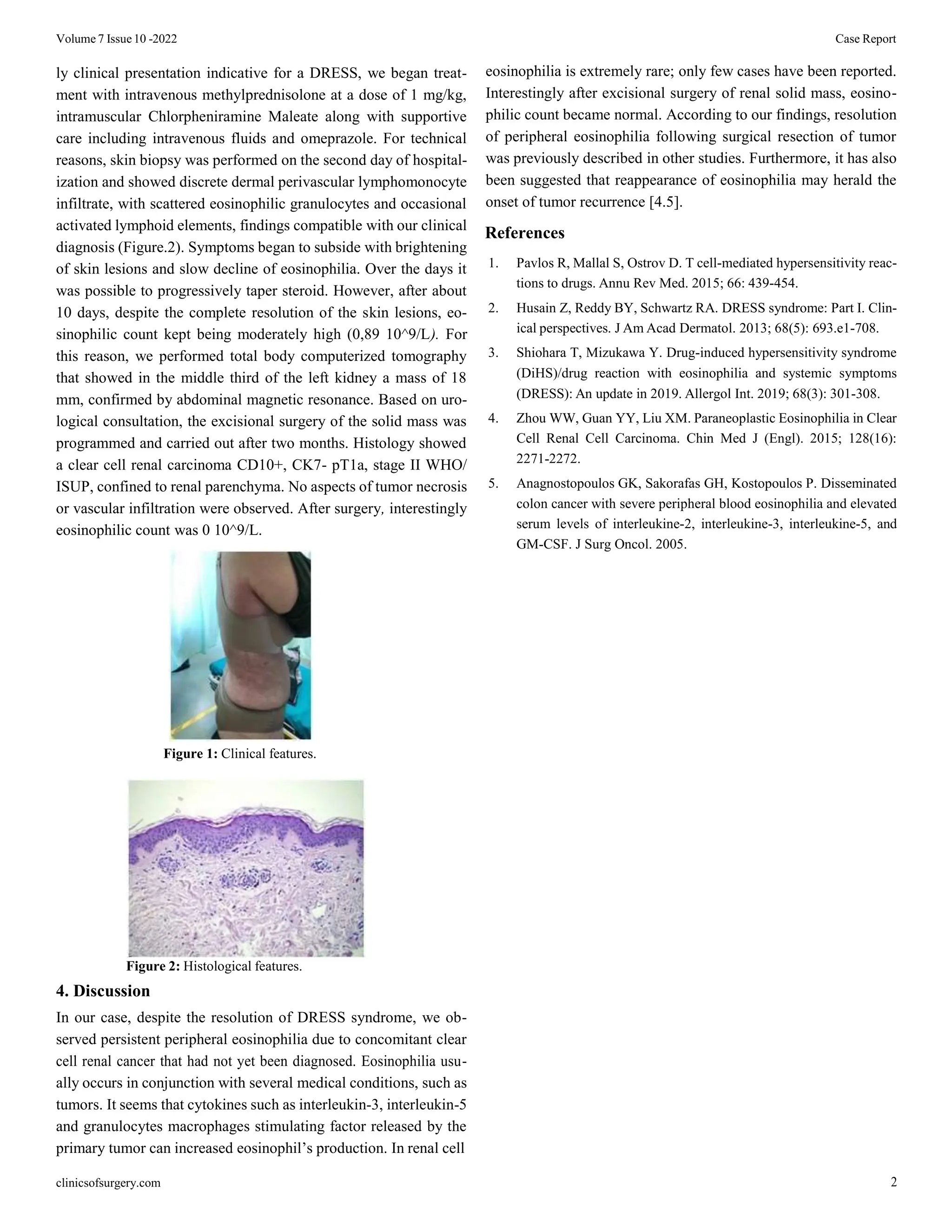 Persistent Eosinophilia After DRESS Syndrome | PDF