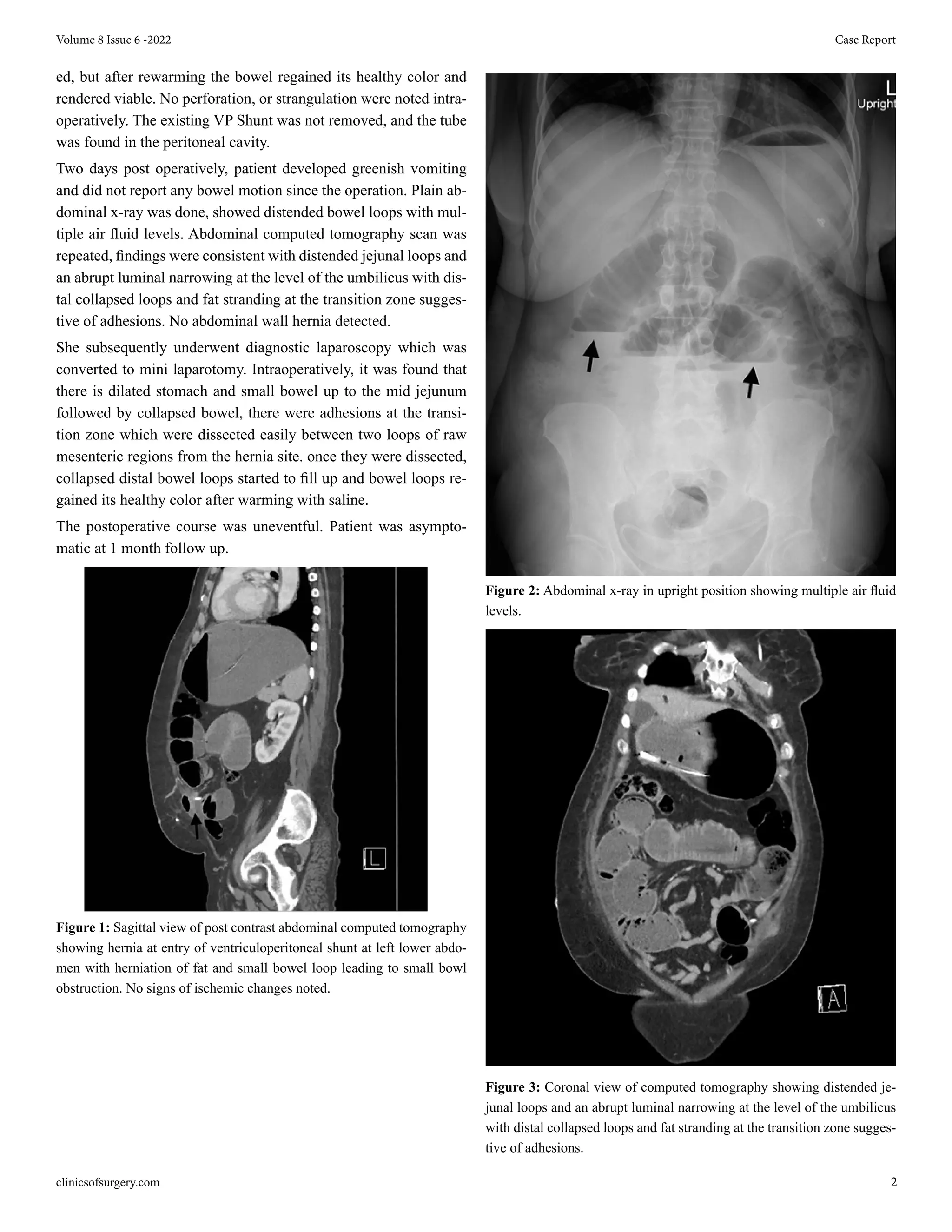 Incisional Hernia Occurring after Ventriculoperitoneal Shunt Fixation | PDF