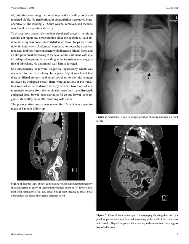 Incisional Hernia Occurring after Ventriculoperitoneal Shunt Fixation | PDF