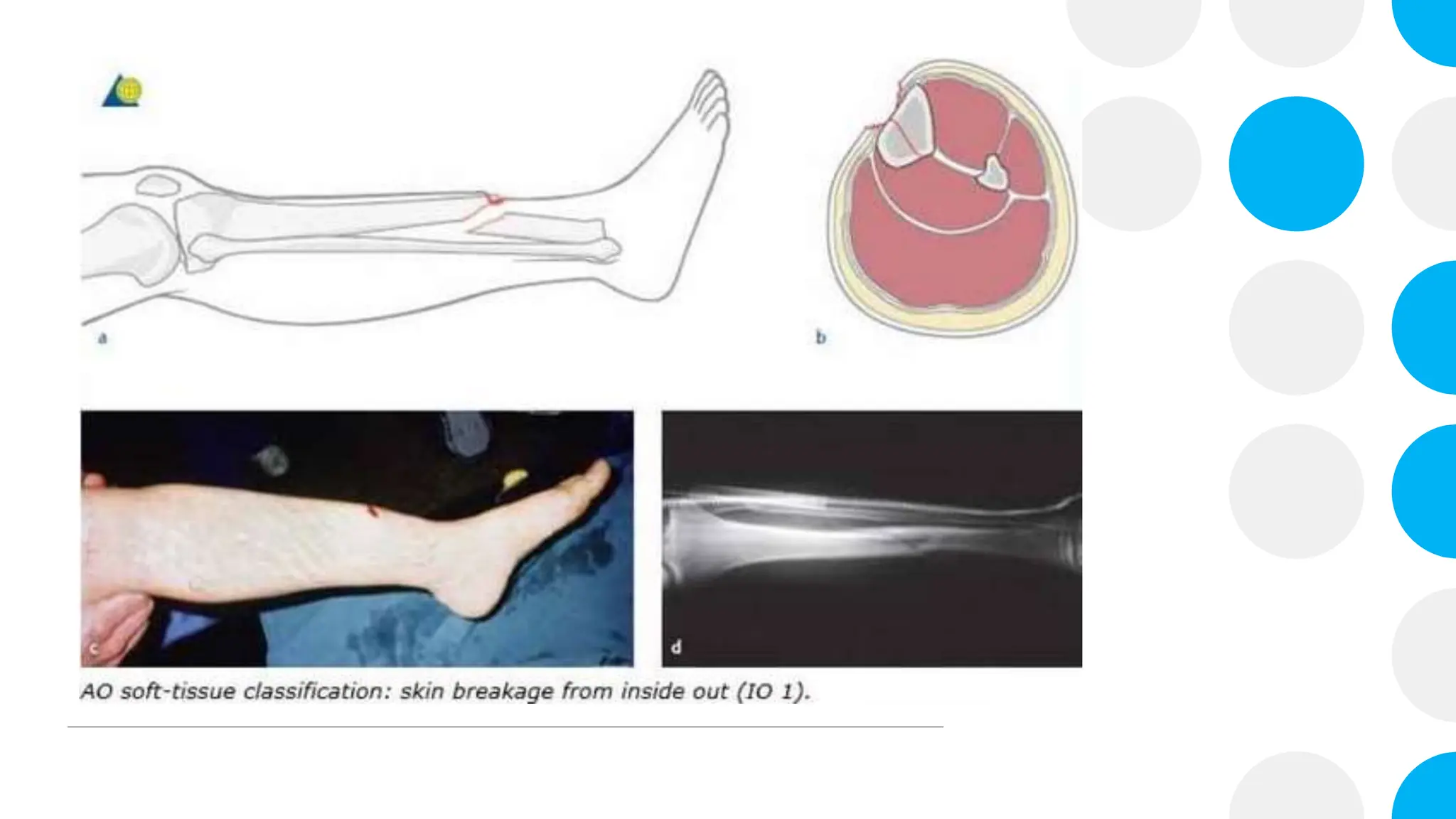 Close soft tissue injuries in fractures.pptx