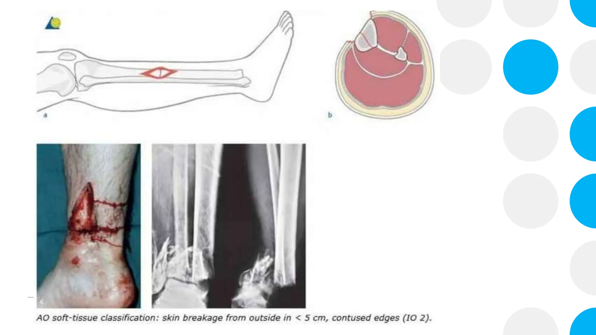 Close soft tissue injuries in fractures.pptx