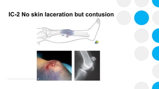 Close soft tissue injuries in fractures.pptx