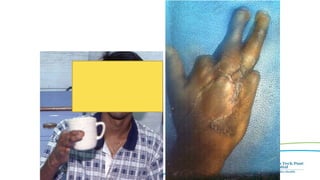 Cosmesis in hand surgery | PPT