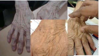 Cosmesis in hand surgery | PPT